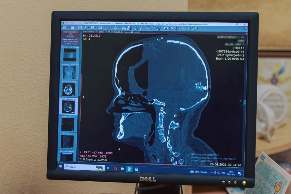 Shrapnel passed through the brain hemisphere: Uman resident ...
